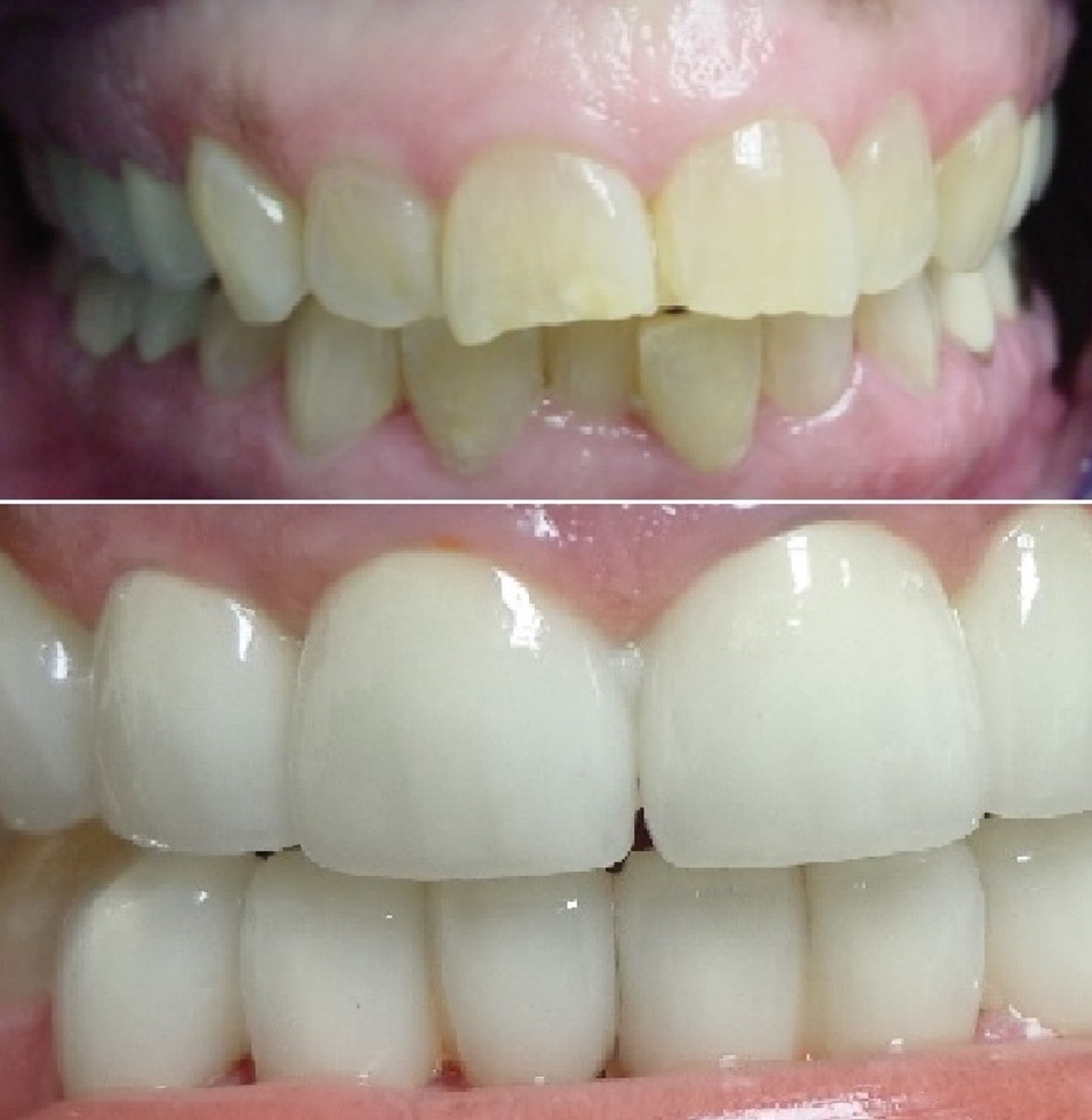 Smile Gallery - Before and After - Dental Care 4U | Before and After ...